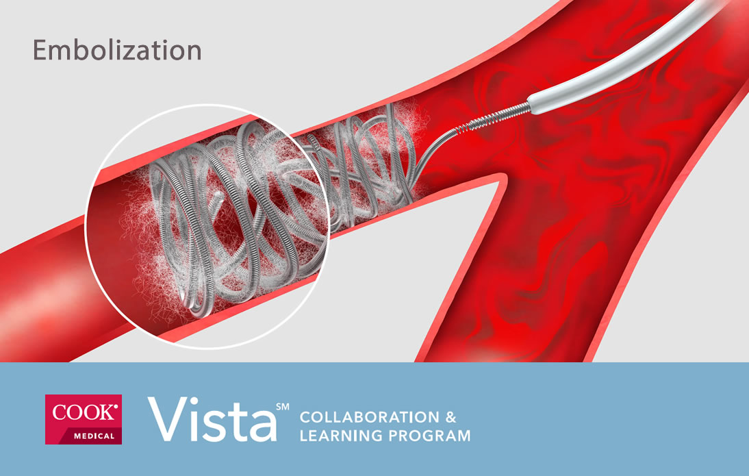 Cook Medical Embolization Workshop | Transmed Pharma